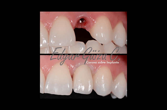 Rehabilitación del diente 22